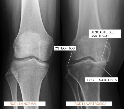 Artrosis, Patología Osteoarticular. Tratamientos y consejos - Viten