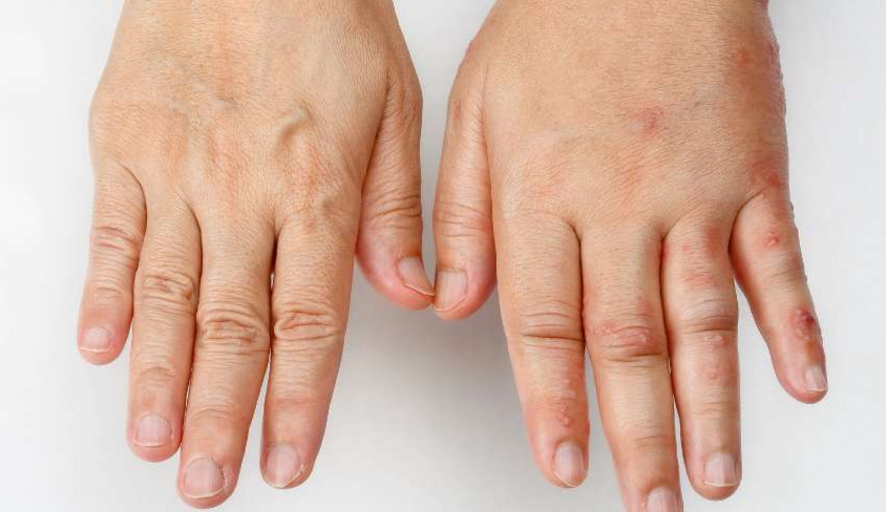 Diferencias entre el síndrome de Haglund y el síndrome de Sudeck