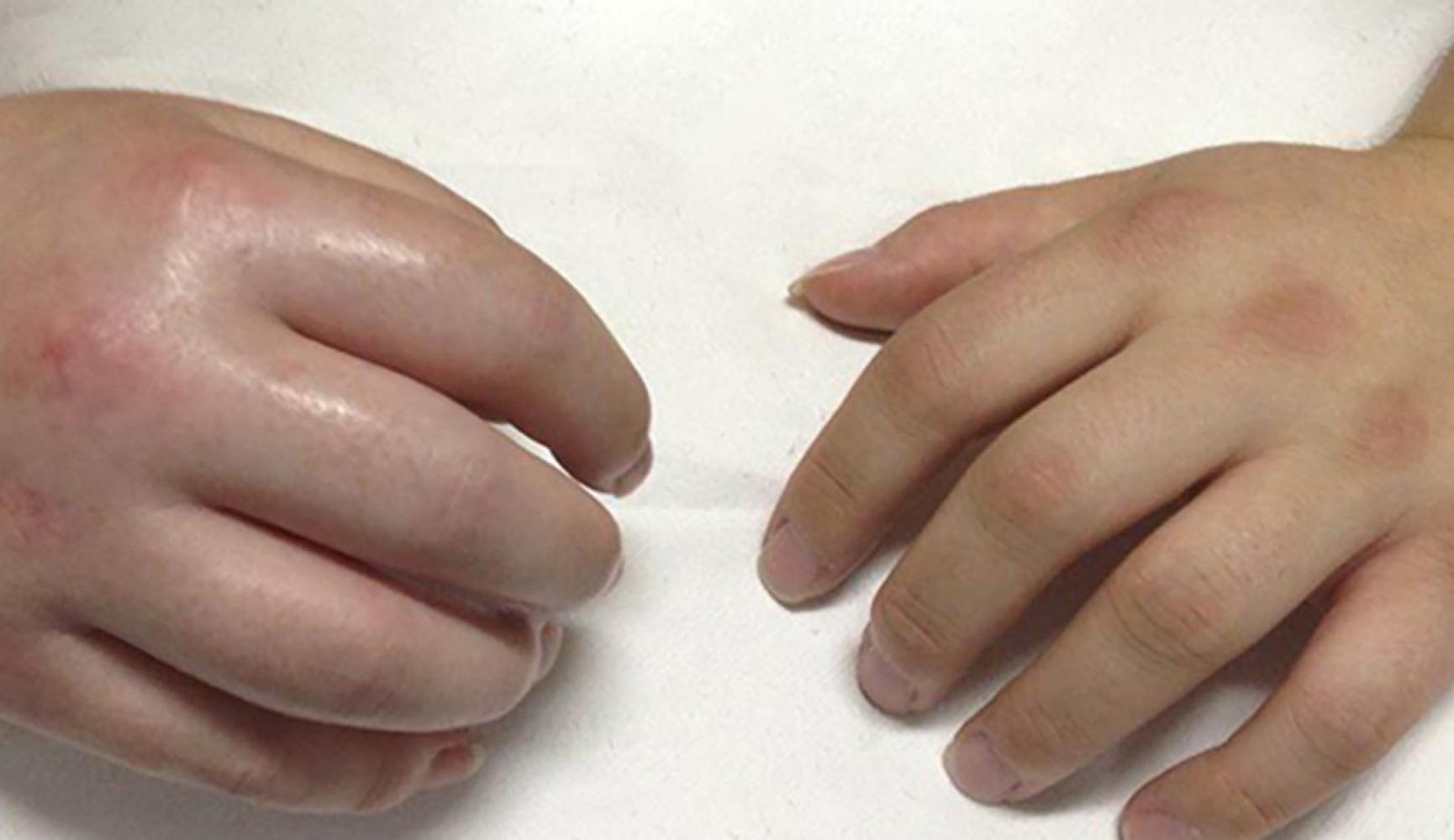¿Qué es el südeck? ¿Cuáles son sus sintomas? - Viten